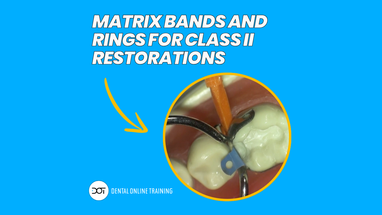 Matrix Bands and Rings for Class II Restorations
