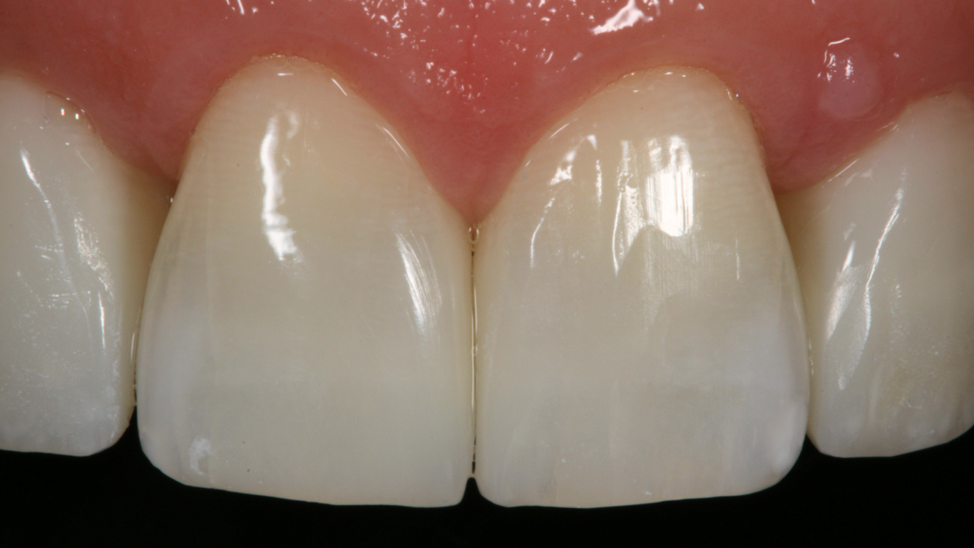 Diastema Closure with Free-hand Bonding