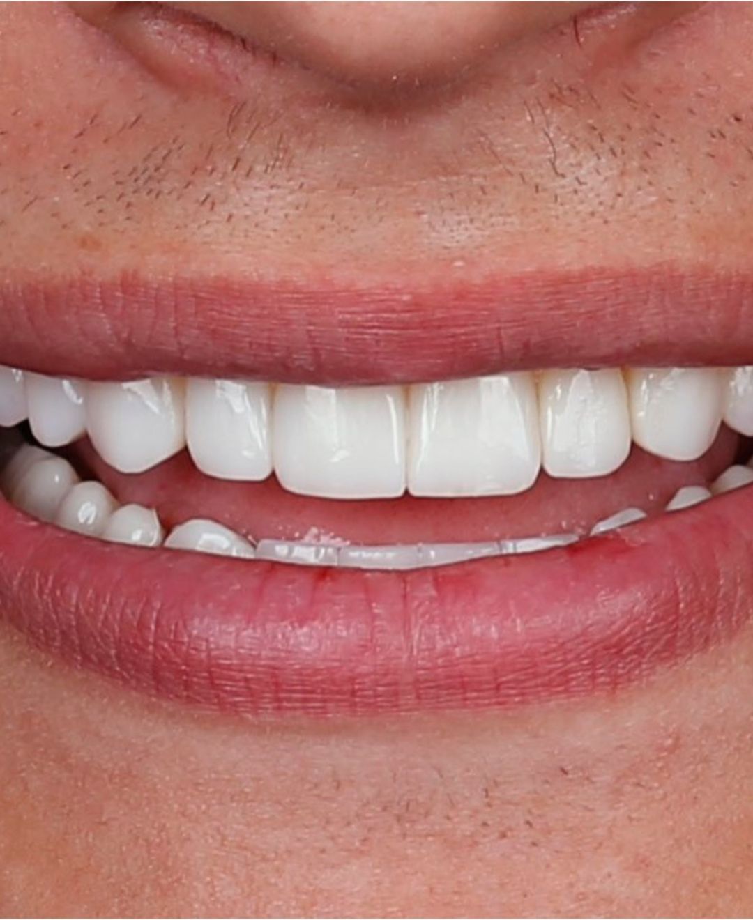 The Ultimate 6 Tooth Veneer