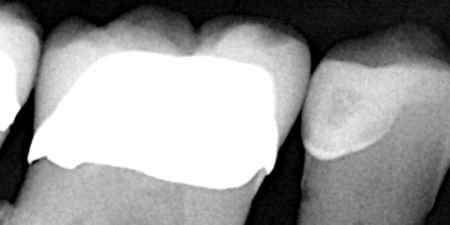 Direct Resin Margin Elevation for Deep Interproximal Cavities.