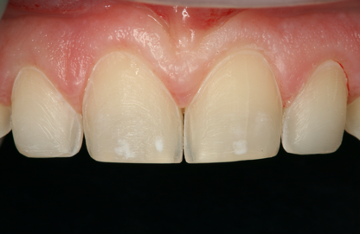 Exquisite Porcelain Veneer Preparation Workshop