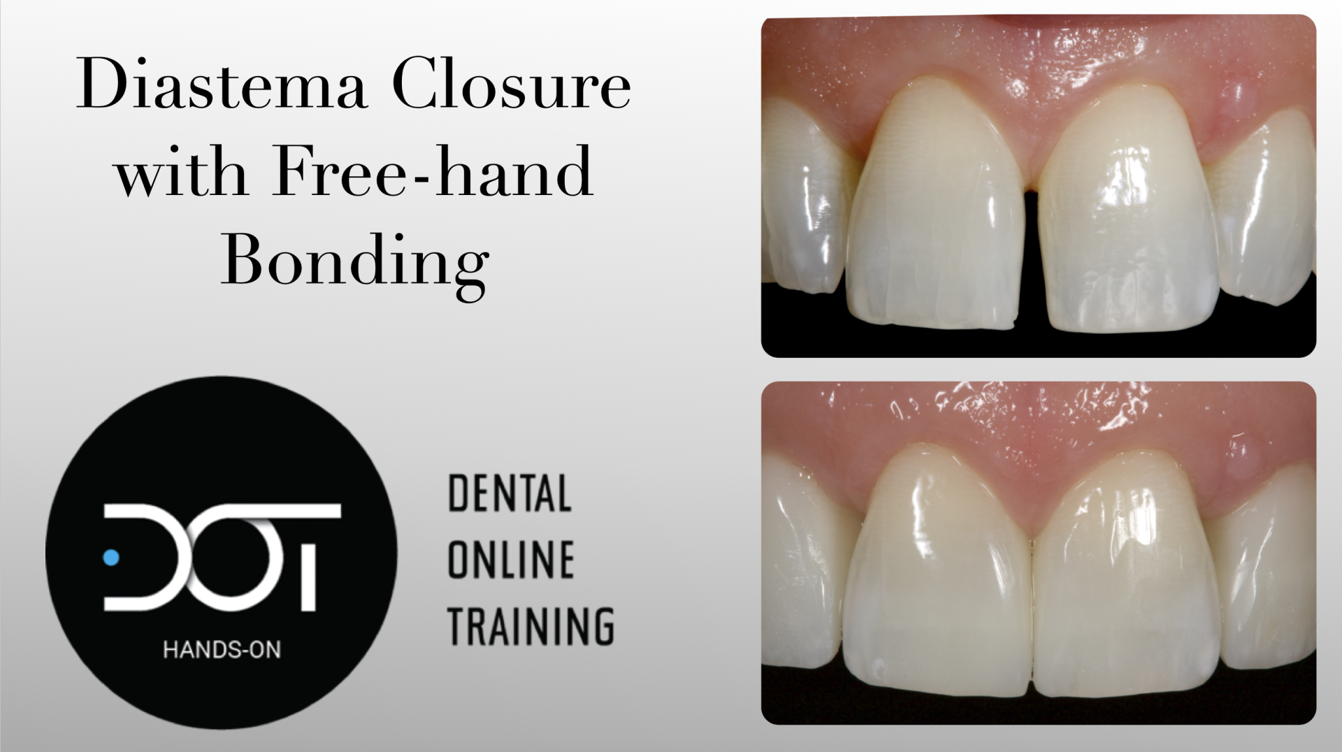 Unlocking the Secrets of Seamless Diastema Closure Restorations