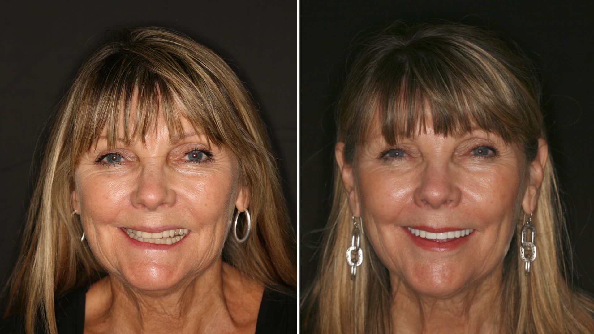 Case Study: TMJ Splint Therapy Success for the TMD patient Case Study: TMJ Splint Therapy Success for the TMD patient
