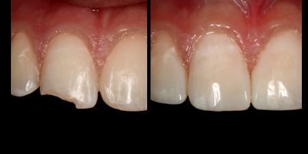 Simplified Class IV Composite Restoration