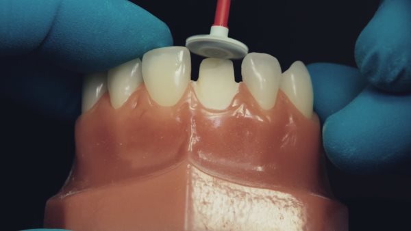 The Esthetic Post and Core