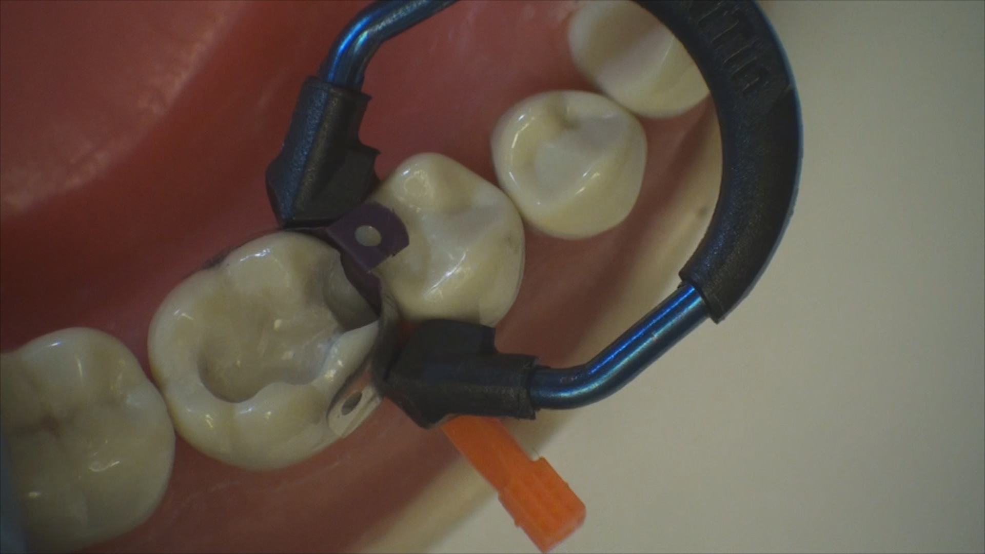 Matrix Bands and Rings for Class II Restorations