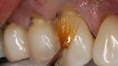 Class V Composite Restoration